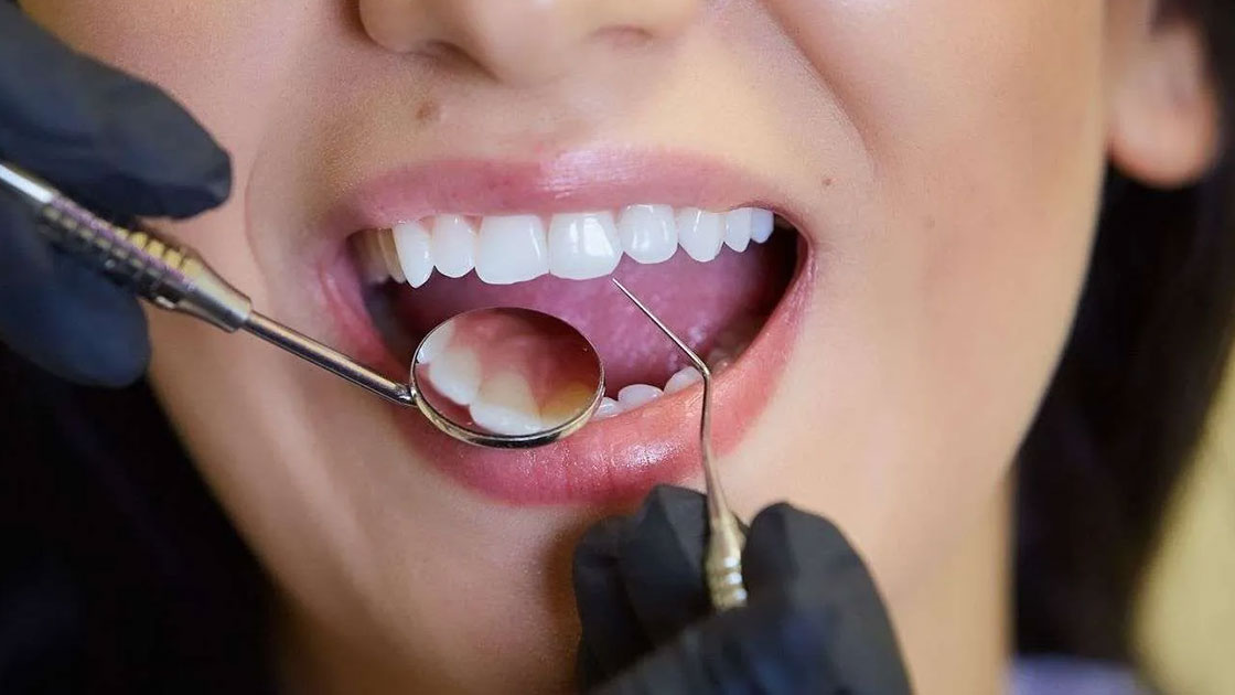 White Filling – Dental Icon
